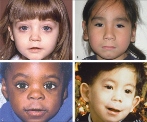 What is FASD? – Let's Get Real Alberta